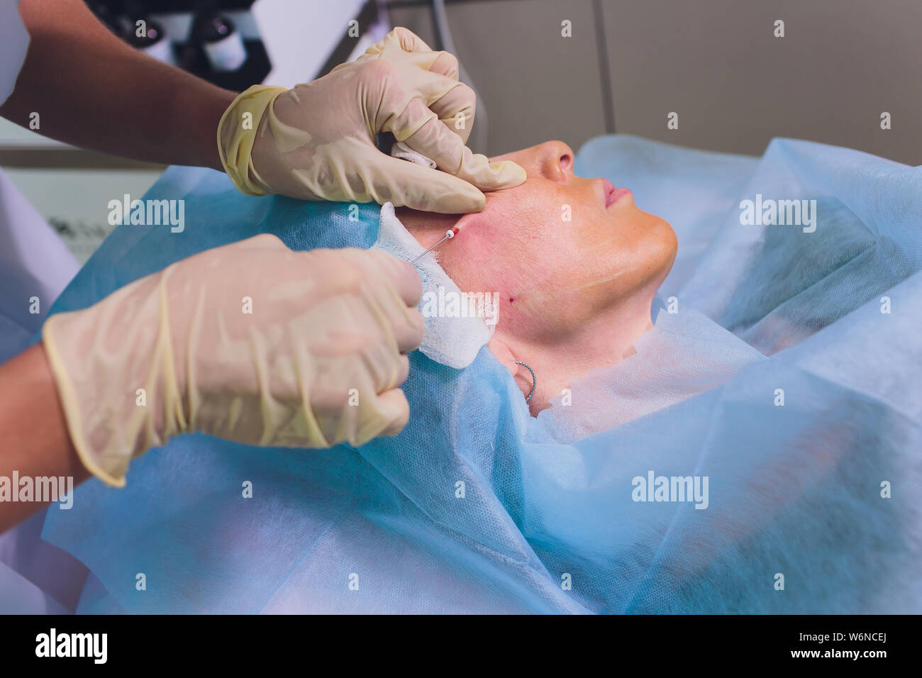 Aged woman doing mesothreads and Thread Lifting, Cosmetology. Cosmetic ...