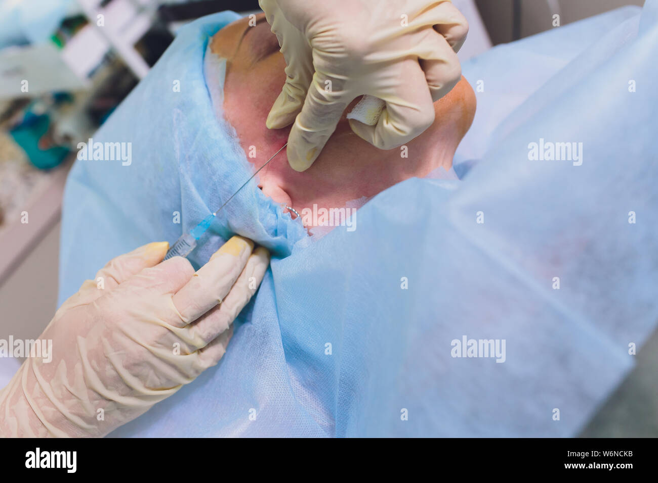 Aged woman doing mesothreads and Thread Lifting, Cosmetology. Cosmetic ...