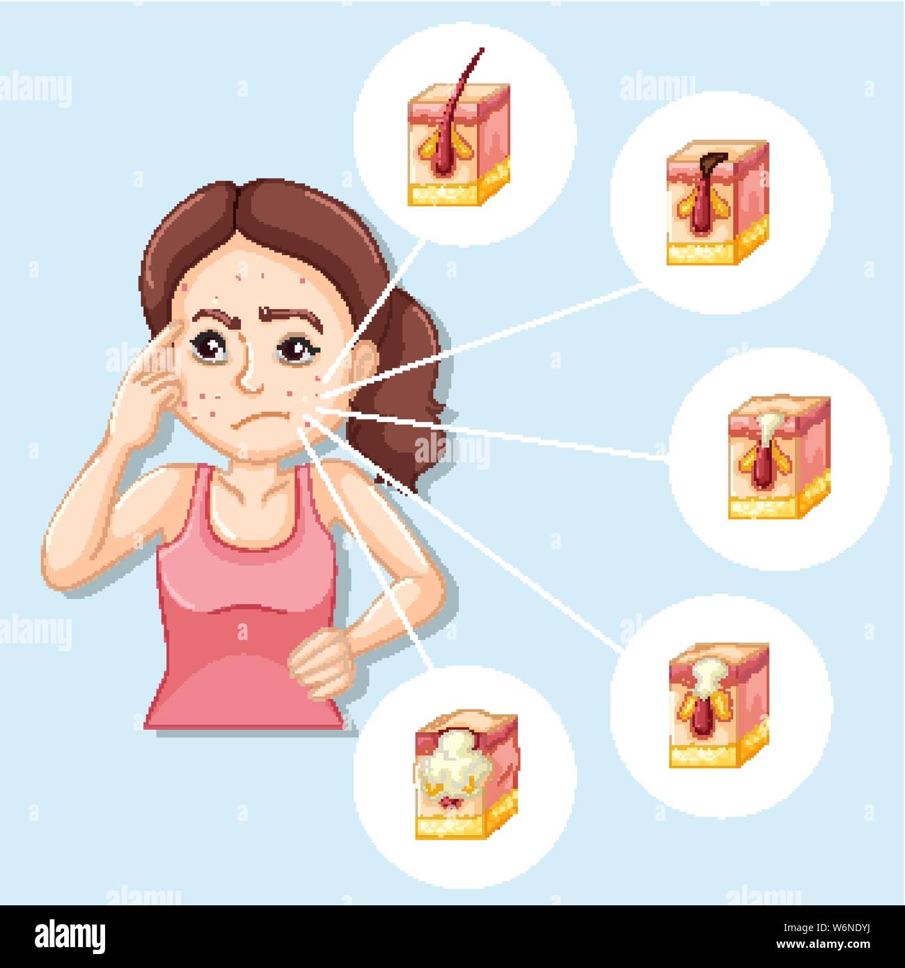 Scientific medical illustration of pimple formation illustration Stock ...