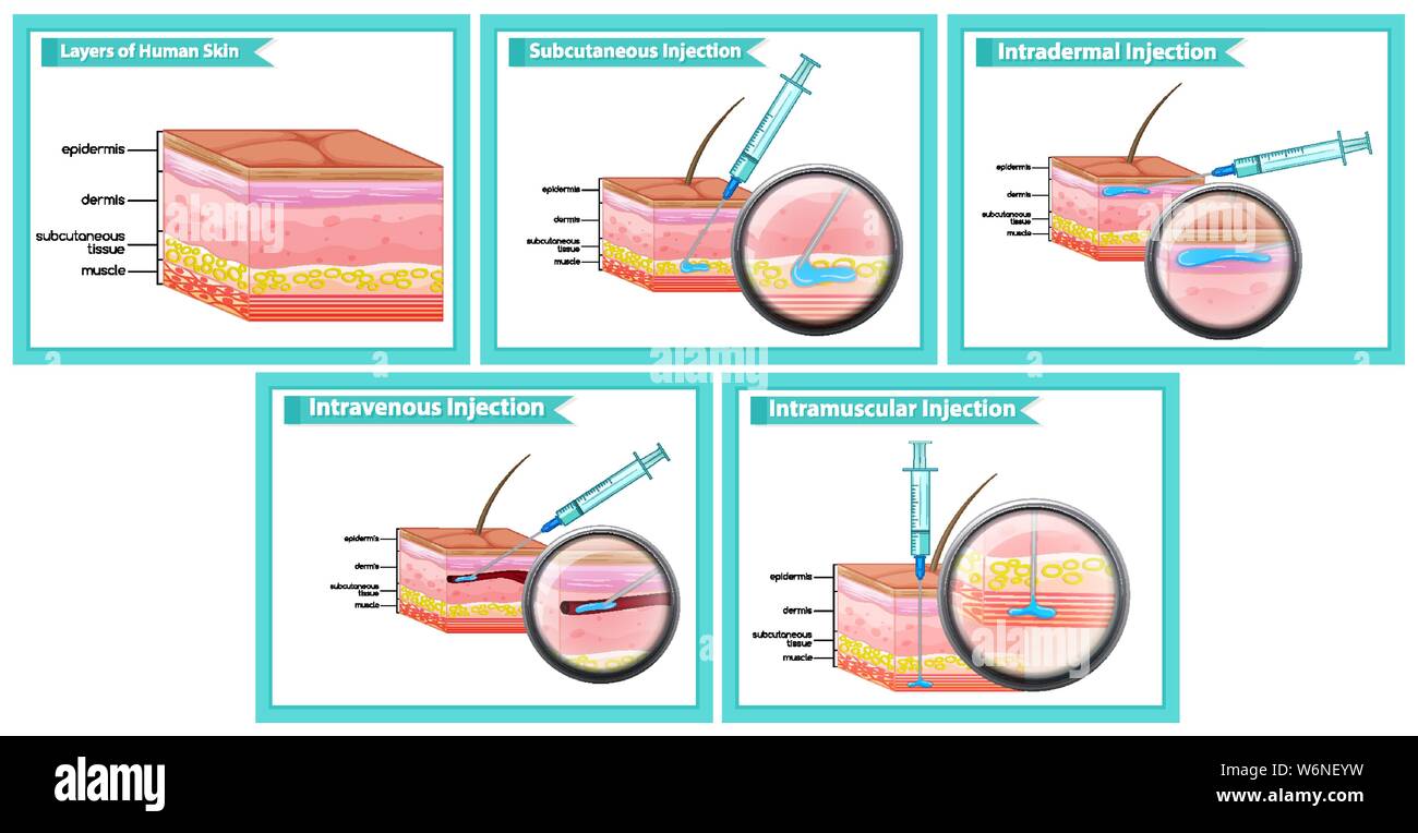 Scientific medical illustration of types of injections illustration ...