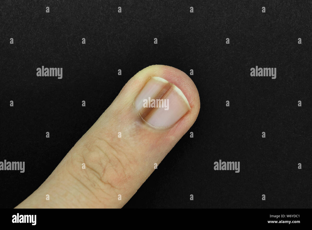 Top view of brown line on male's nail finger better known as ...