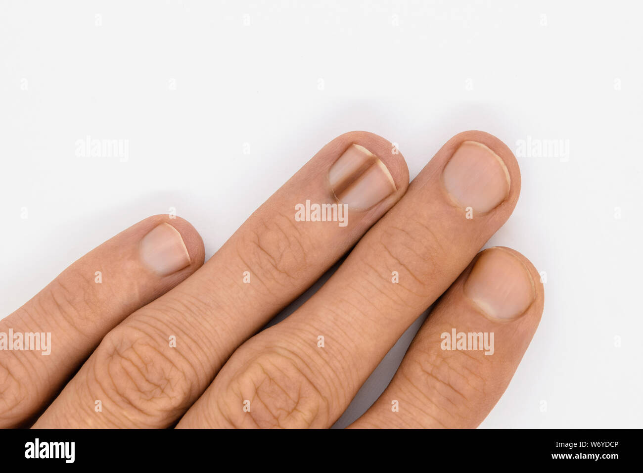 Top view of male hand with brown line on one of the finger's nail ...