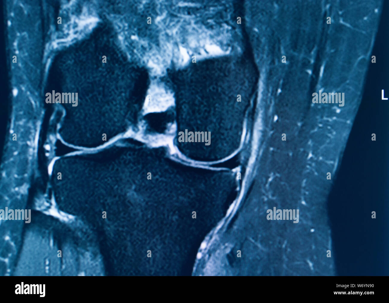 Knee sports injury mri mcl grade 2 tear magnetic resonance imaging ...