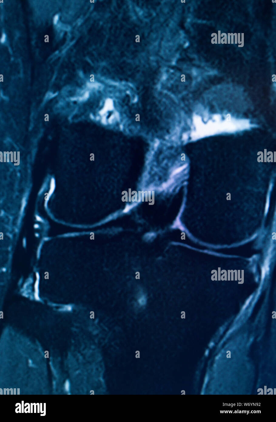 Knee sports injury mri mcl grade 2 tear magnetic resonance imaging ...