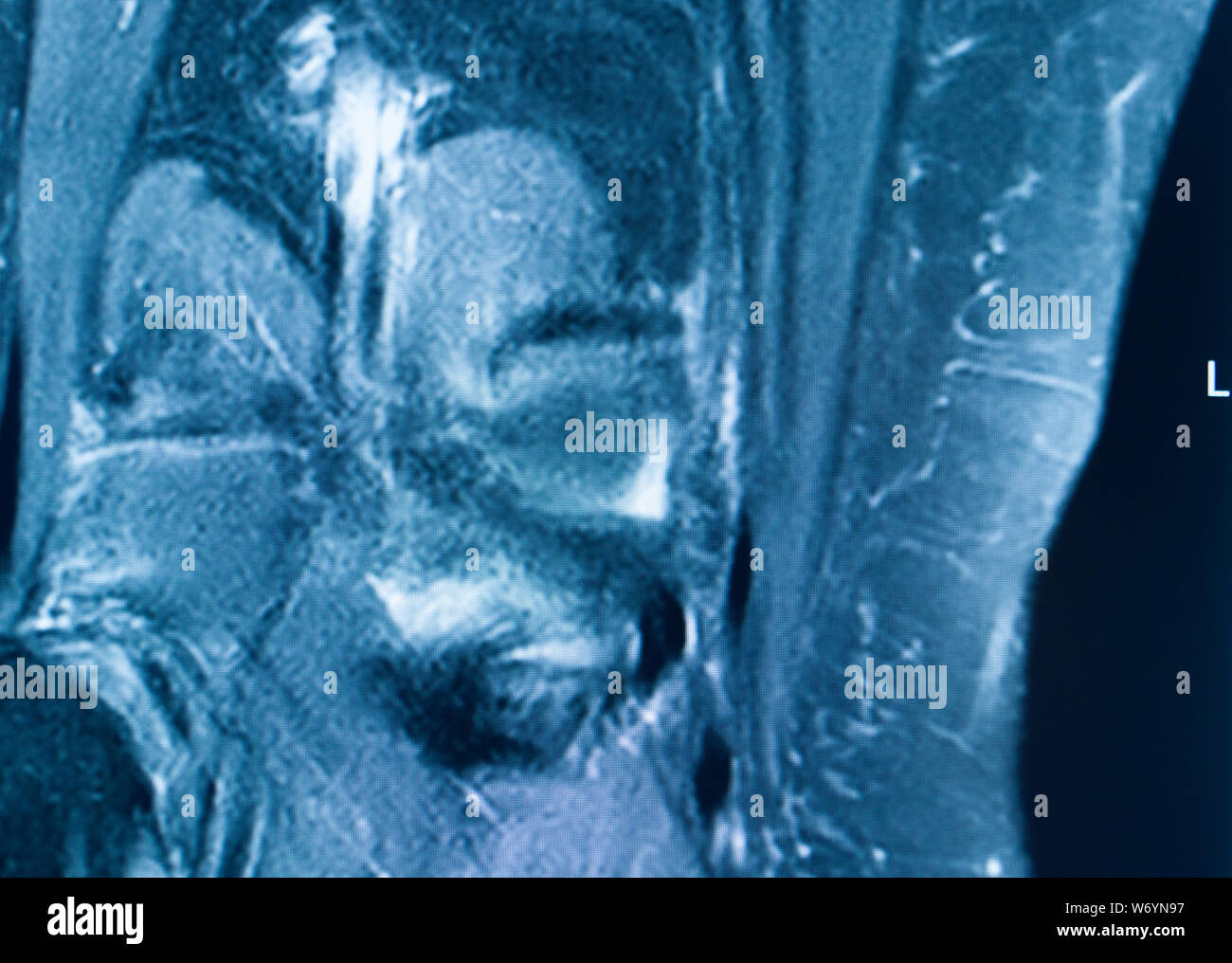 Knee sports injury mri mcl grade 2 tear magnetic resonance imaging ...