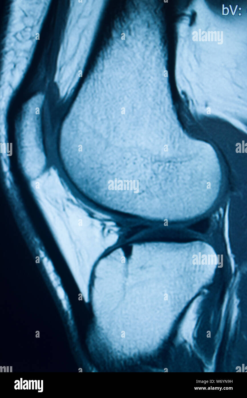 Knee sports injury mri mcl grade 2 tear magnetic resonance imaging ...
