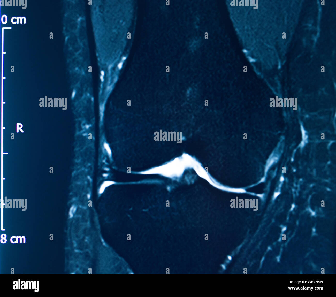 Knee sports injury mri mcl grade 2 tear magnetic resonance imaging ...