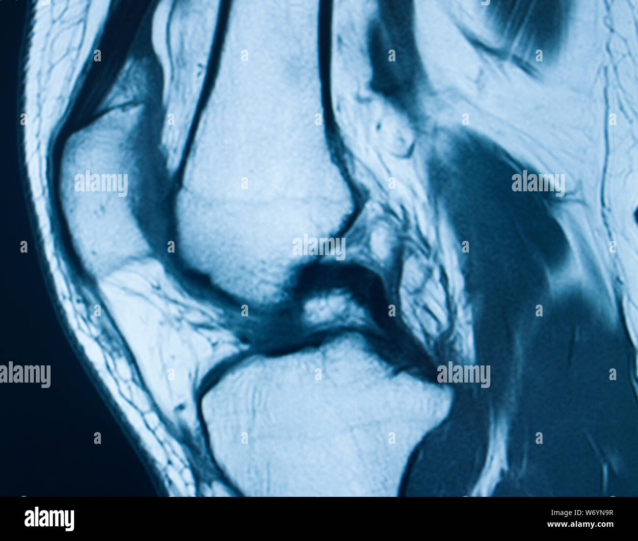 Knee sports injury mri mcl grade 2 tear magnetic resonance imaging ...