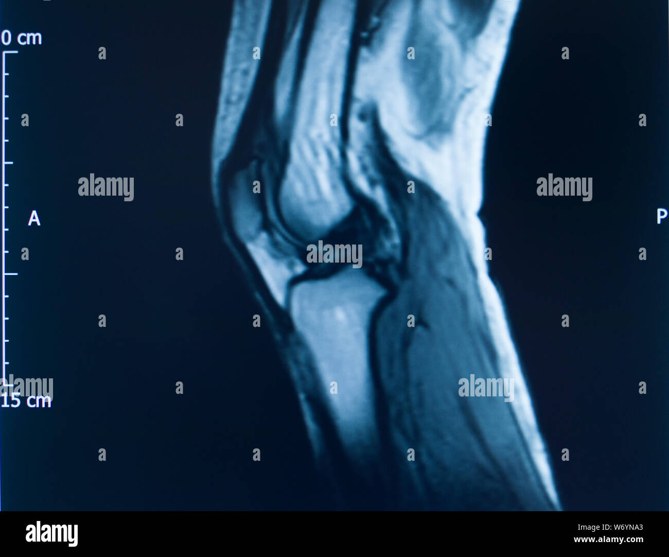 Knee sports injury mri mcl grade 2 tear magnetic resonance imaging ...