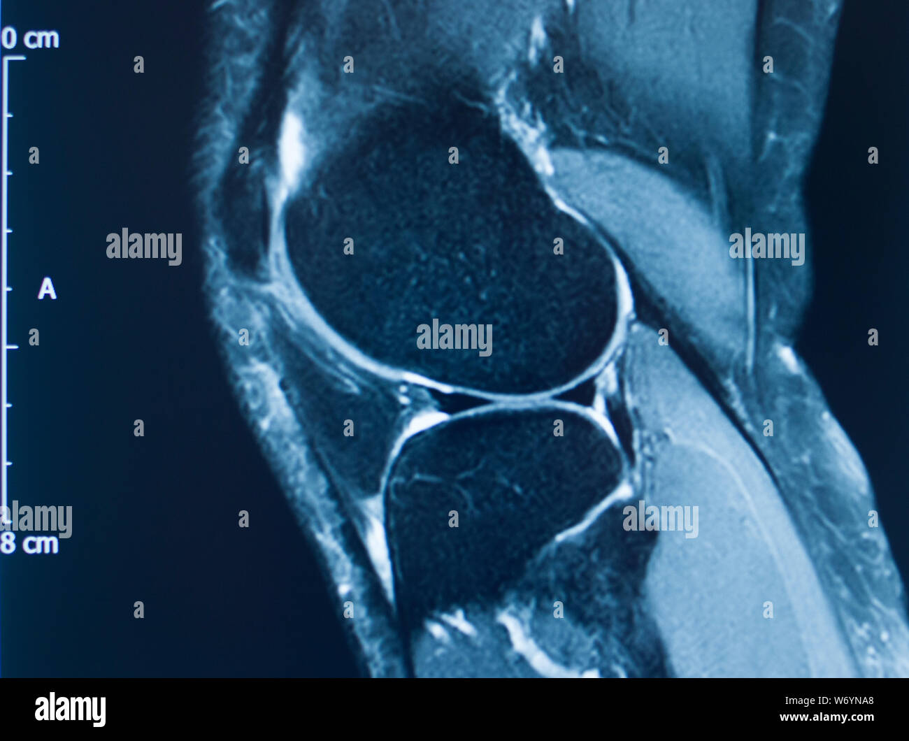 Knee sports injury mri mcl grade 2 tear magnetic resonance imaging ...
