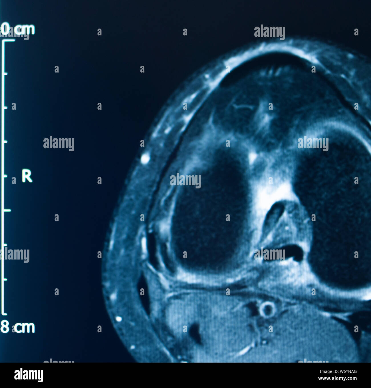 Knee sports injury mri mcl grade 2 tear magnetic resonance imaging ...