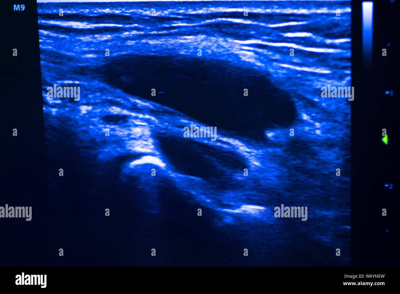 EPI Intratissue Percutaneous Electrolysis dry needling ultrasound ...