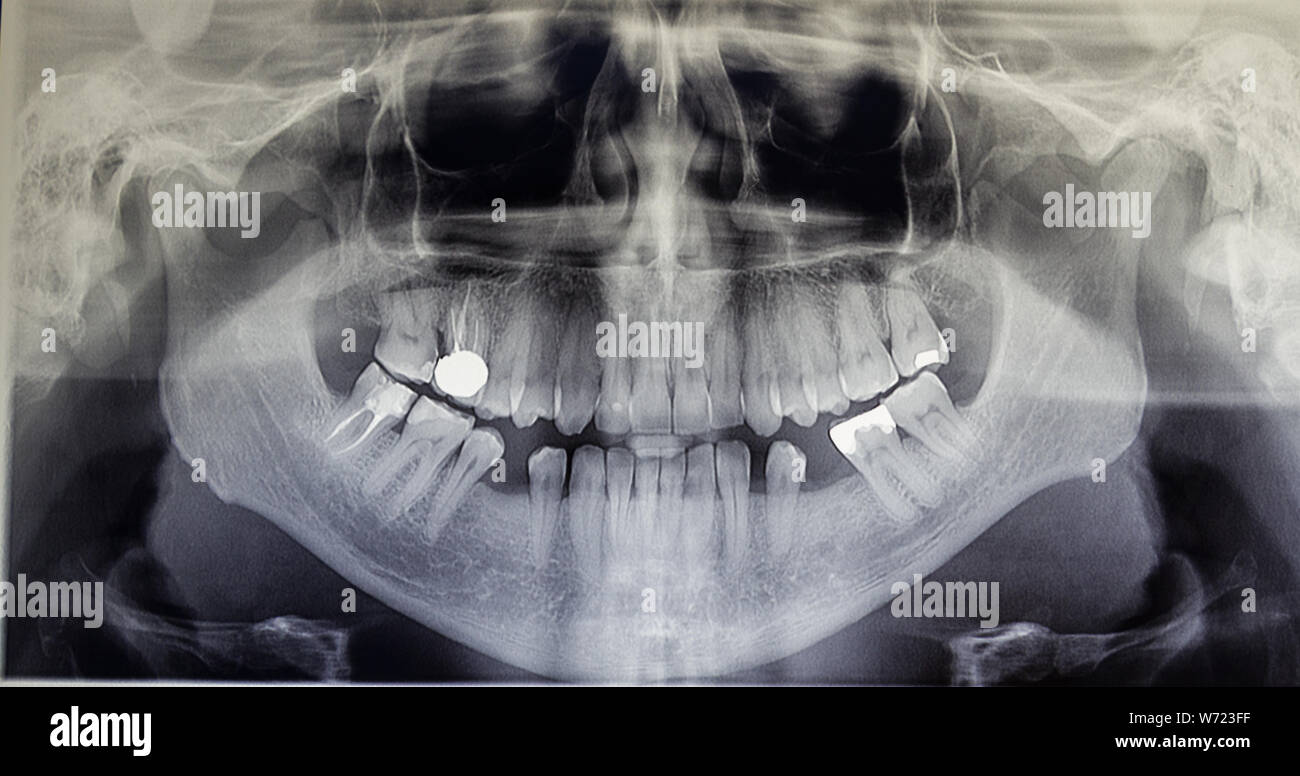 Orthopantomography of an adult patient Stock Photo - Alamy