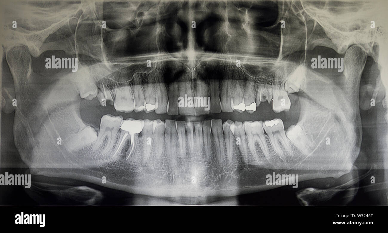 Orthopantomography of an adult patient Stock Photo - Alamy