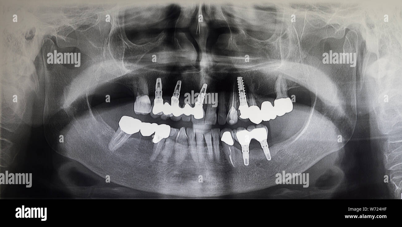 Orthopantomography of an adult patient Stock Photo - Alamy