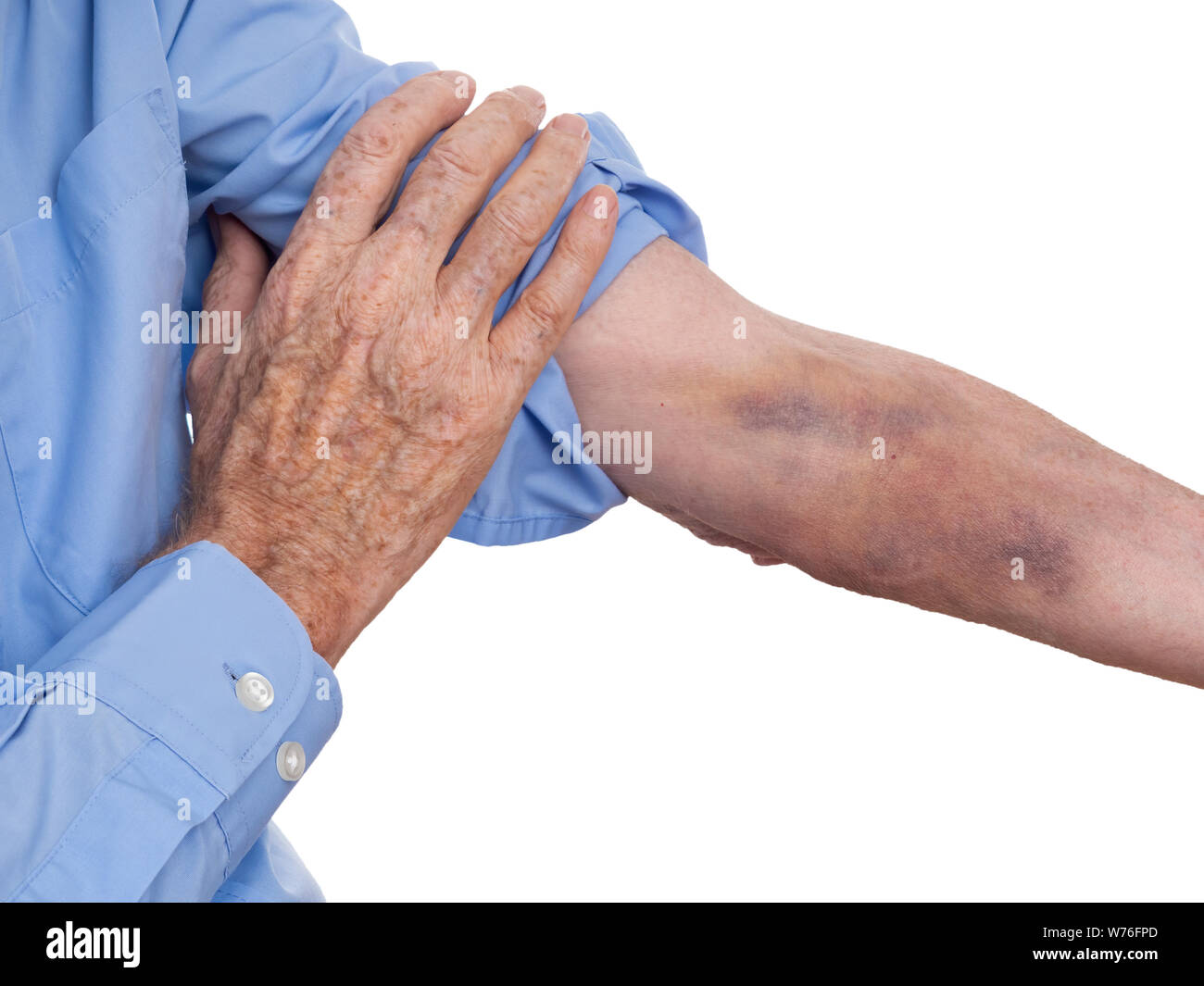 Bruise On Arm From Hand