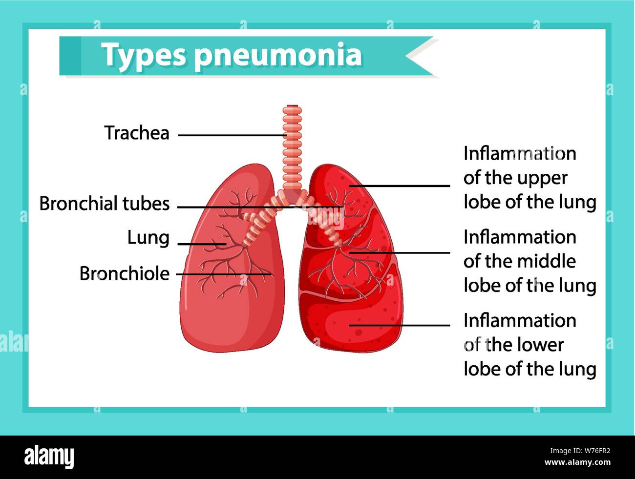 Scientific medical illustration of pneumonia illustration Stock Vector ...
