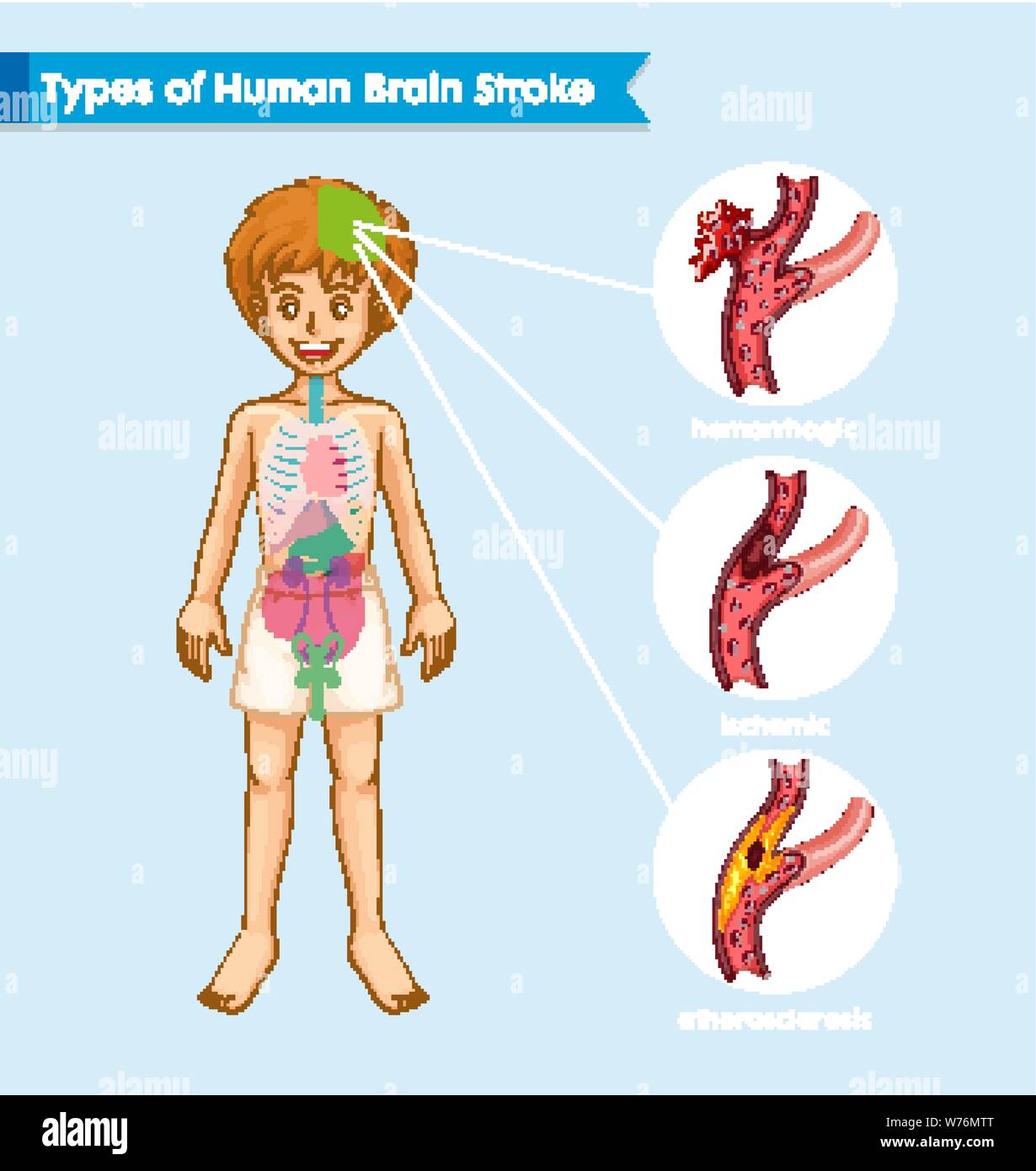Scientific medical illustration of brain stroke concept illustration ...