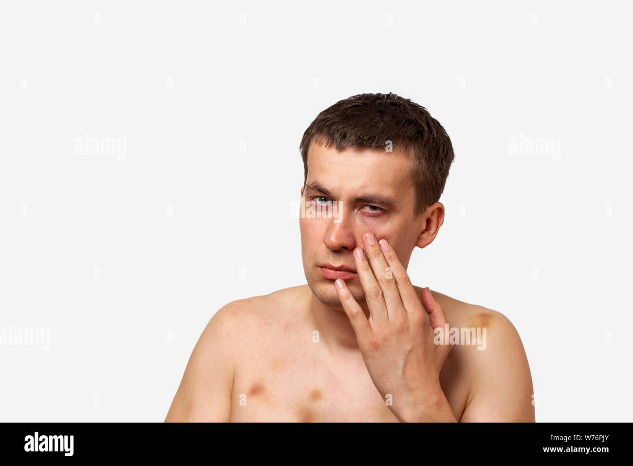 Brunette man with bruises on his body holds his hand to his head in ...