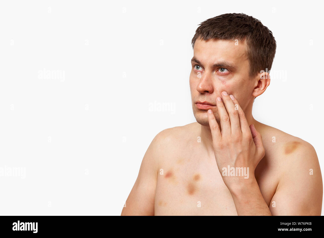 Brunette man with bruises on his body holds his hand to his head in ...