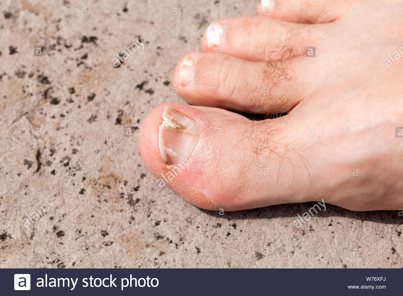 Big Toe Stock Photos & Big Toe Stock Images - Alamy