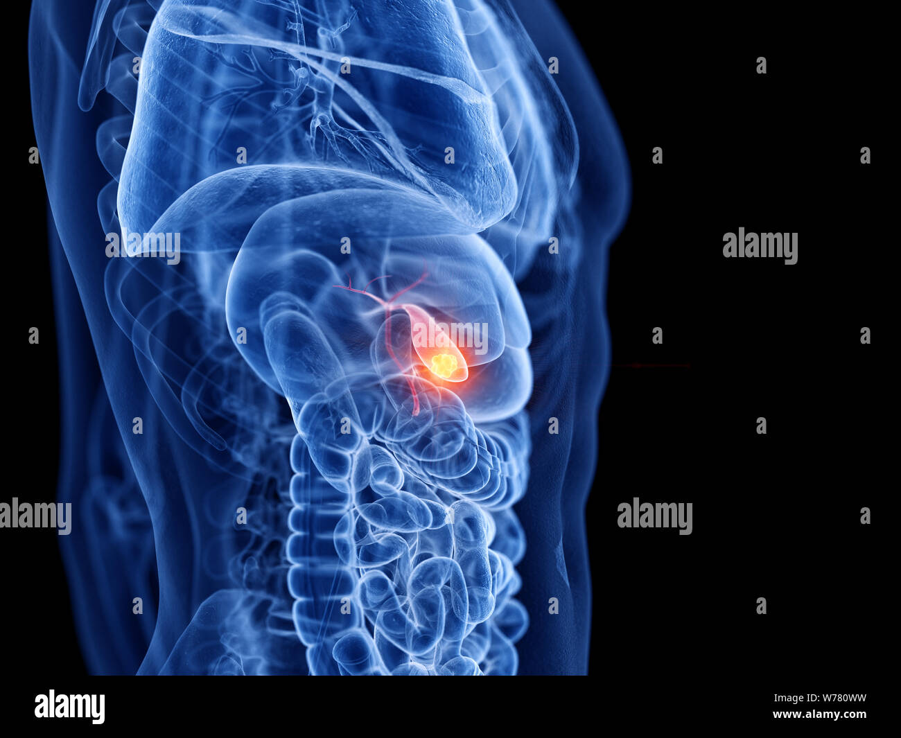 3d rendered medically accurate illustration of the gallbladder cancer ...