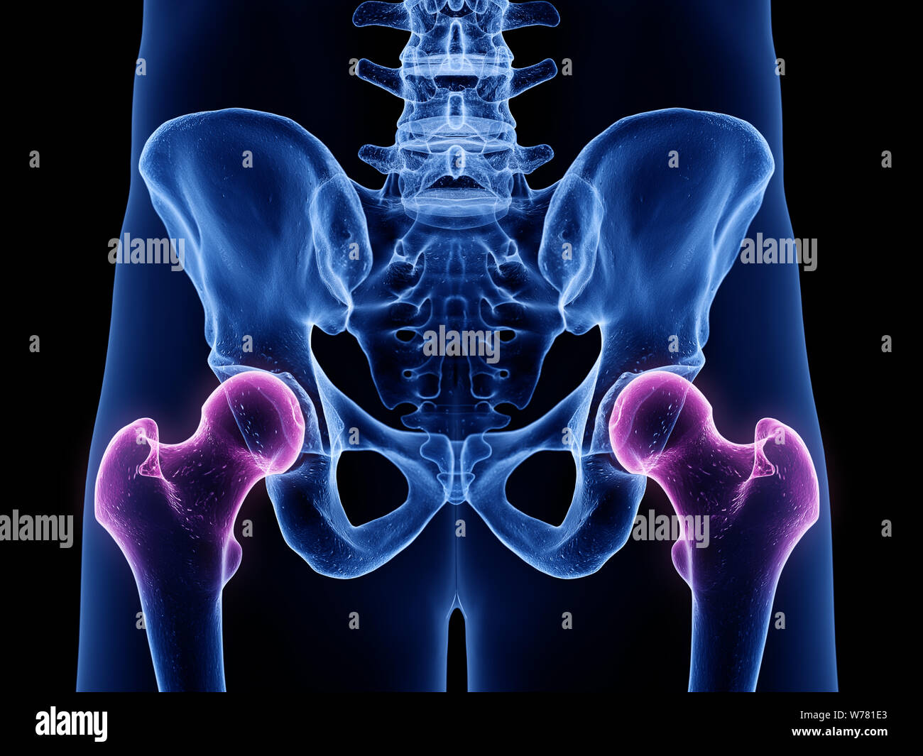 Hip joints hi-res stock photography and images - Alamy