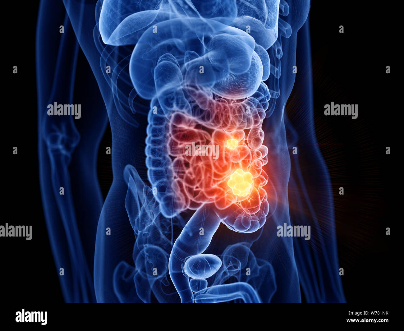 3d rendered medically accurate illustration of small intestine cancer ...