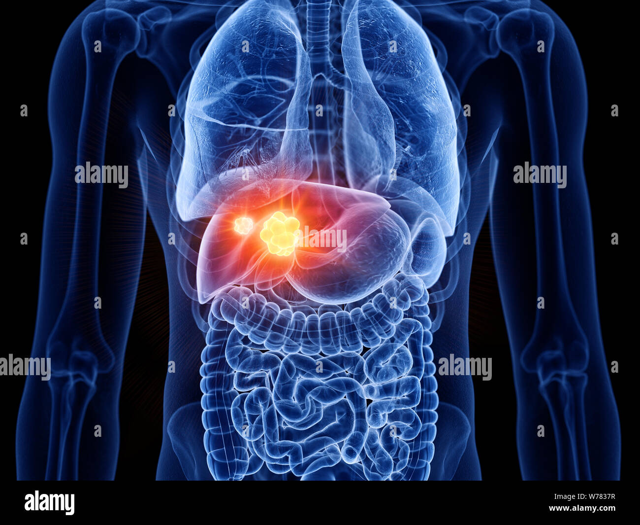 3d rendered medically accurate illustration of liver cancer Stock Photo ...