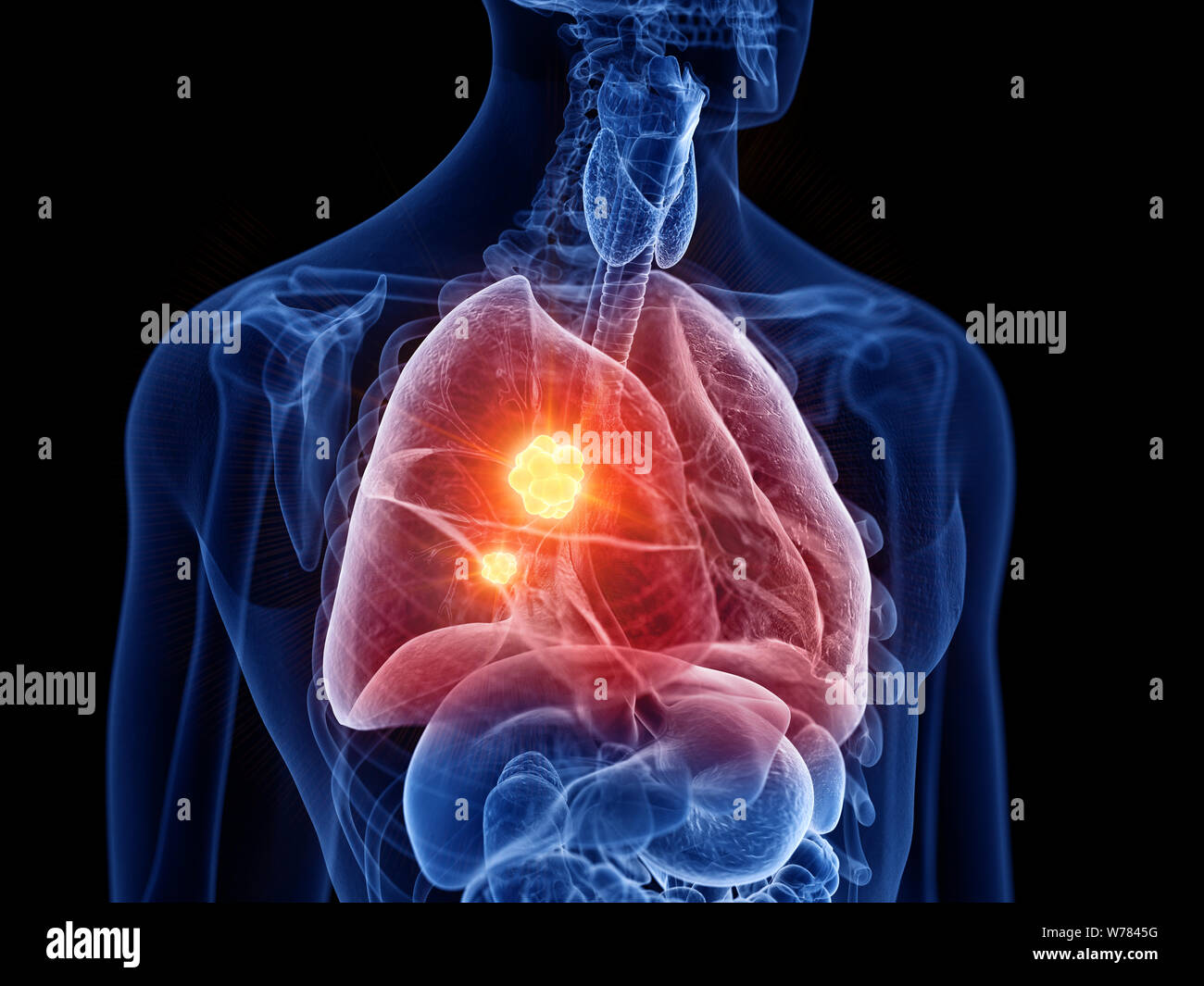 3d rendered medically accurate illustration of lung cancer Stock Photo ...