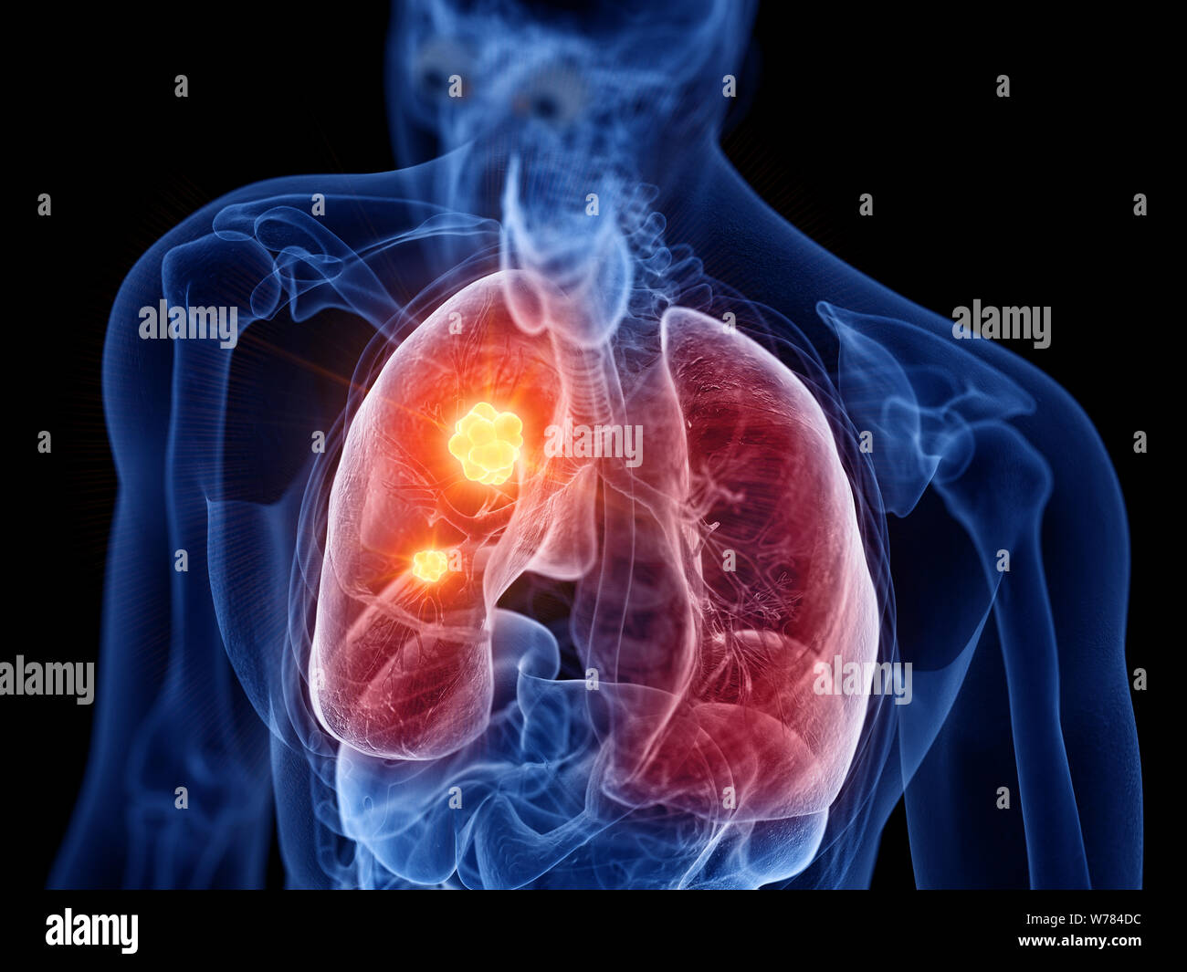 3d rendered medically accurate illustration of lung cancer Stock Photo ...