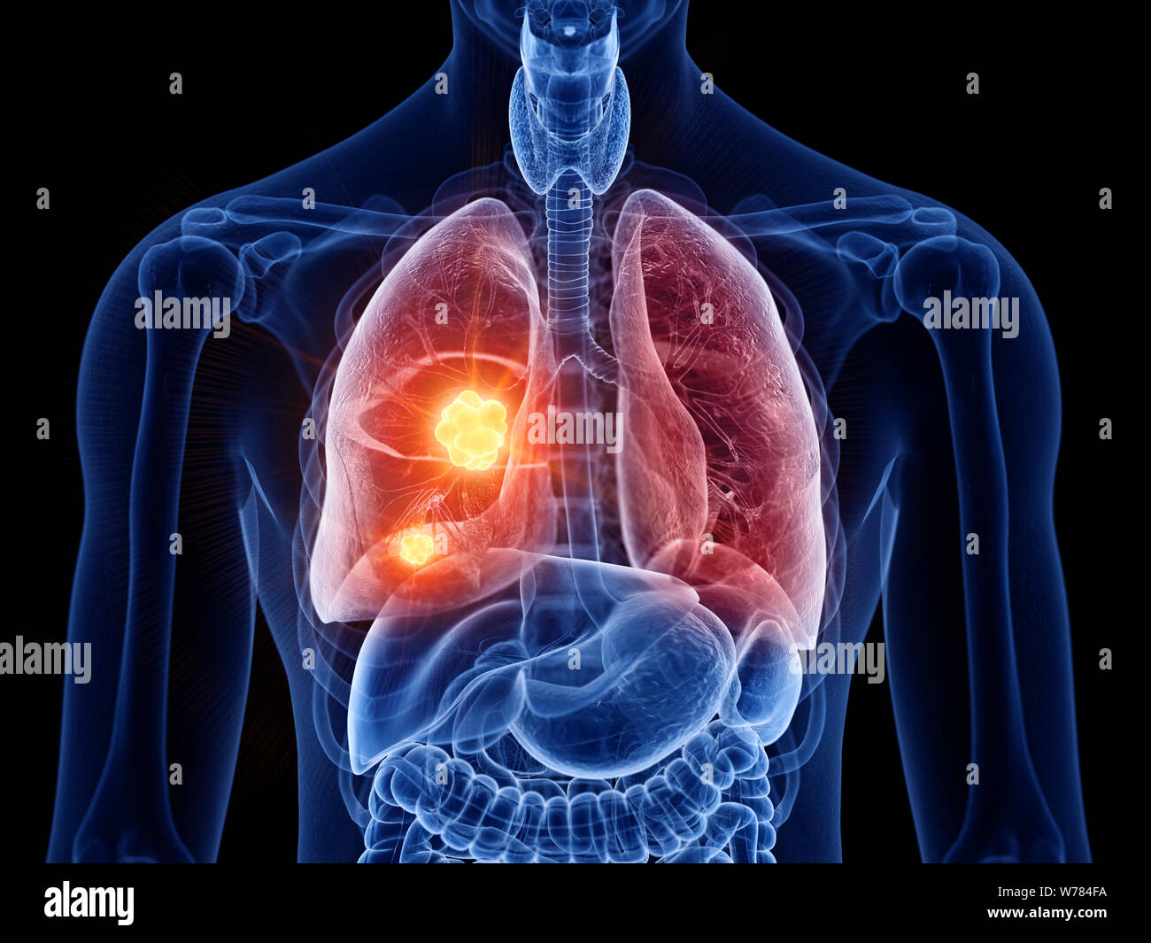 Lung cancer pulmonary organs hi-res stock photography and images - Alamy