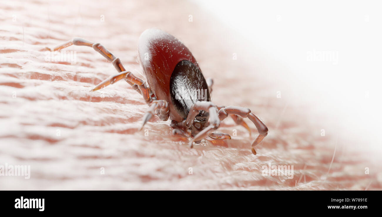 3d rendered illustration of a tick biting in human skin Stock Photo - Alamy