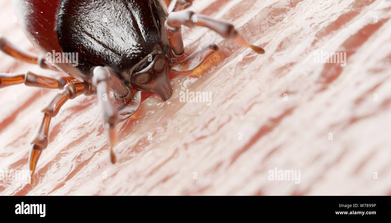 3d rendered illustration of a tick biting in human skin Stock Photo - Alamy
