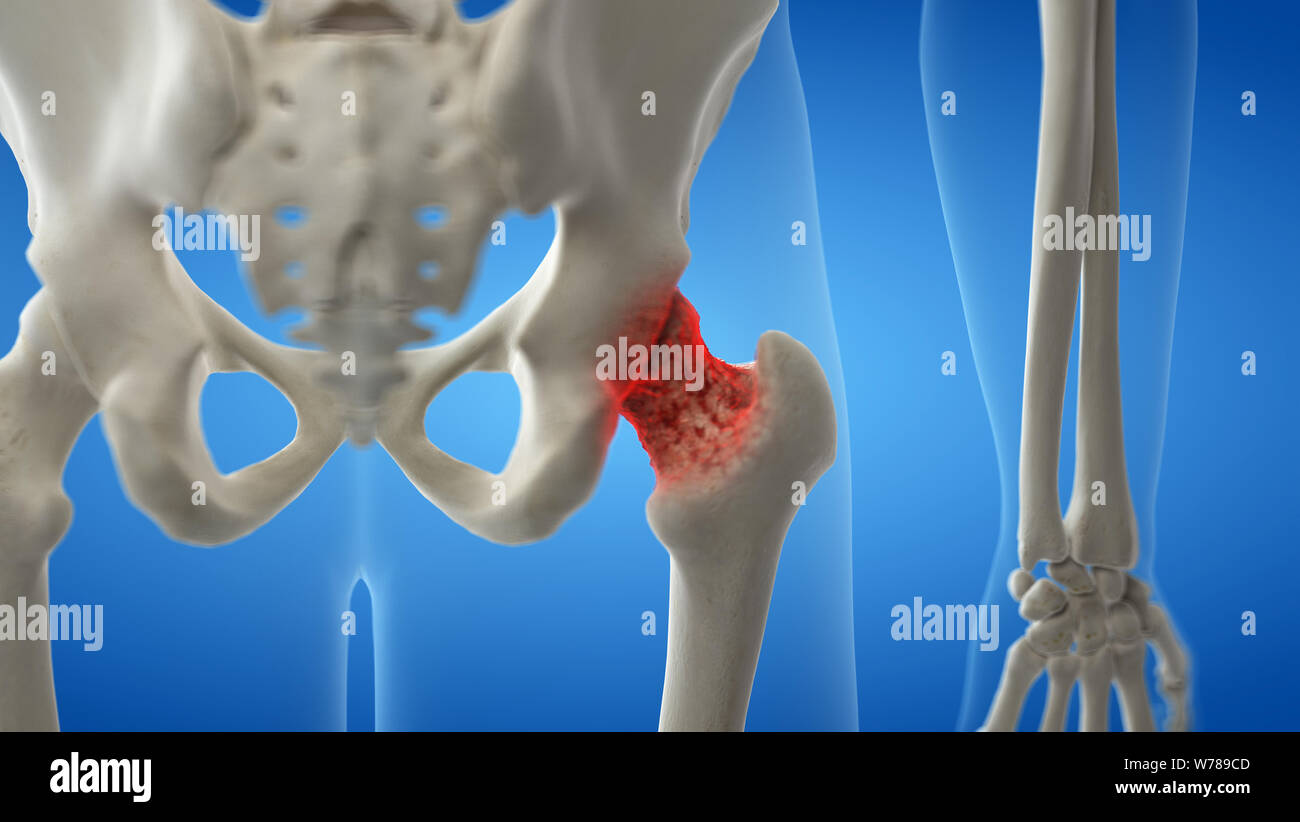 Diagram anatomy of hip illustration hi-res stock photography and images ...