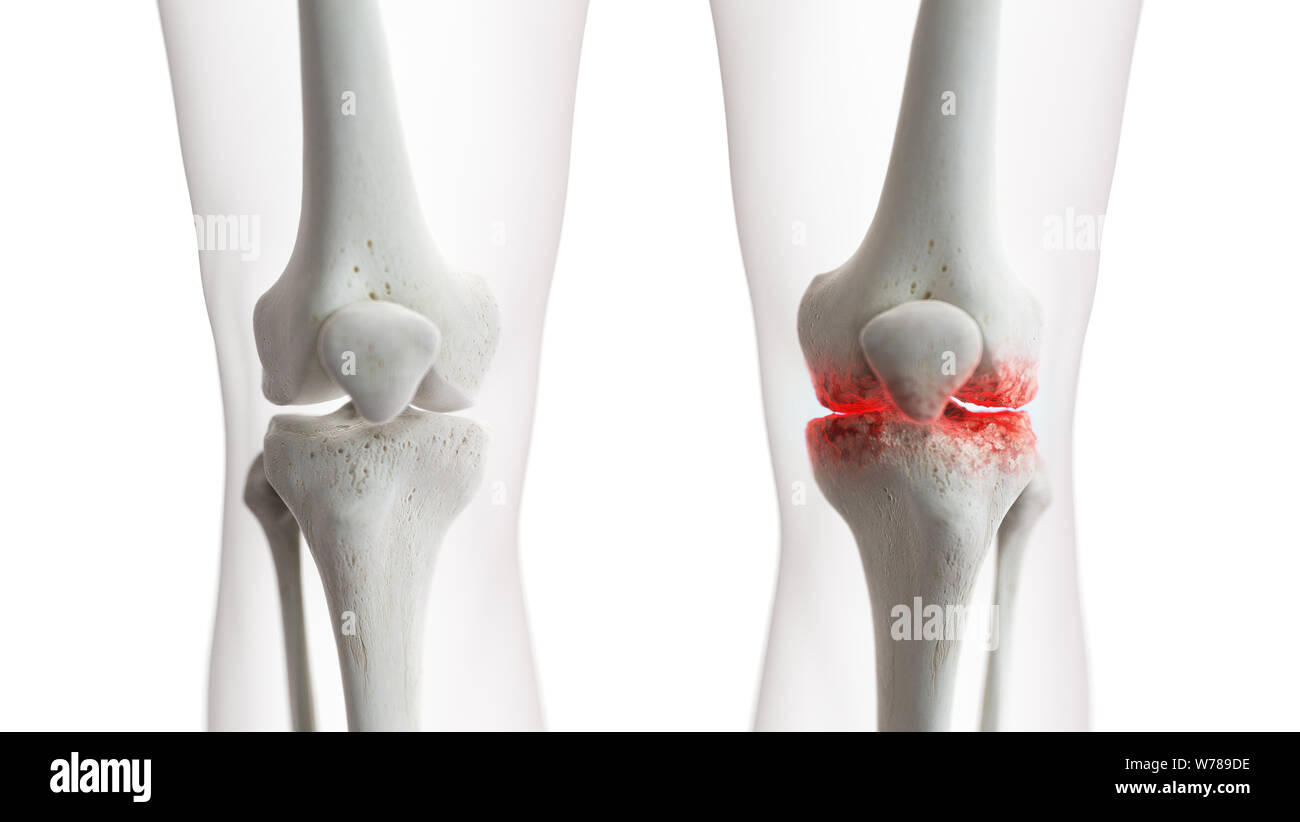 3d rendered medically accurate illustration of an arthritic knee joint ...