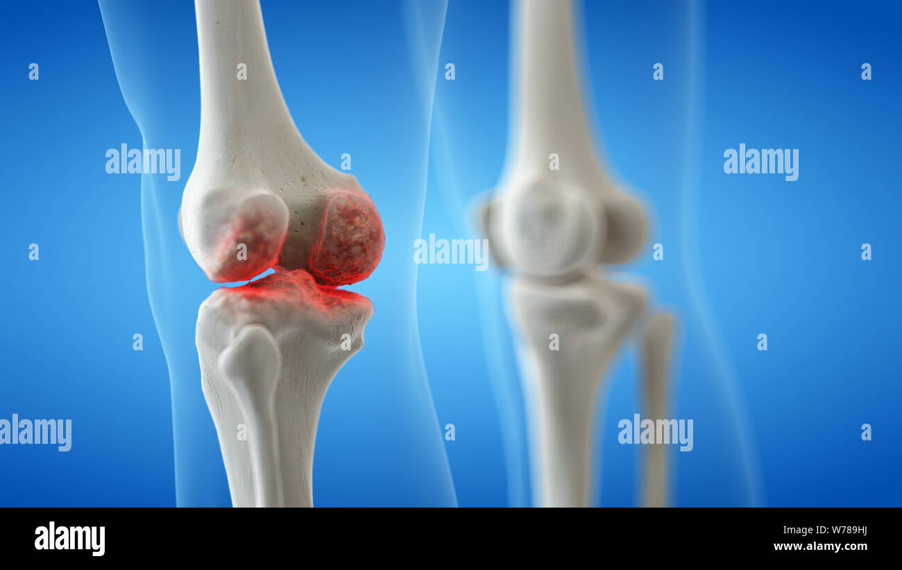 3d rendered medically accurate illustration of an arthritic knee joint ...