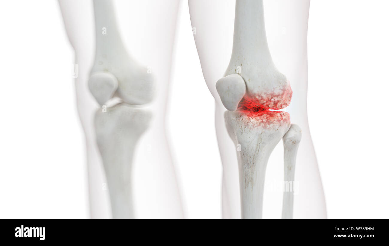 3d rendered medically accurate illustration of an arthritic knee joint ...