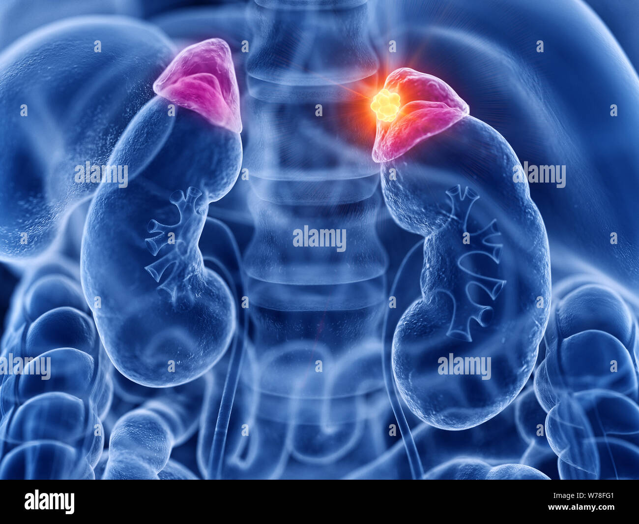 Adrenal gland tumor hi-res stock photography and images - Alamy