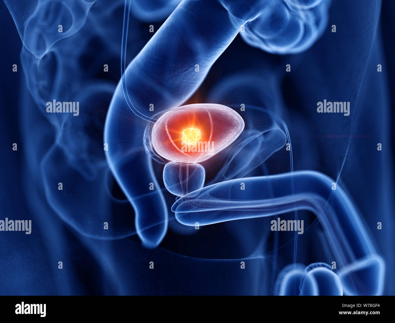 3d rendered medically accurate illustration of bladder cancer Stock ...