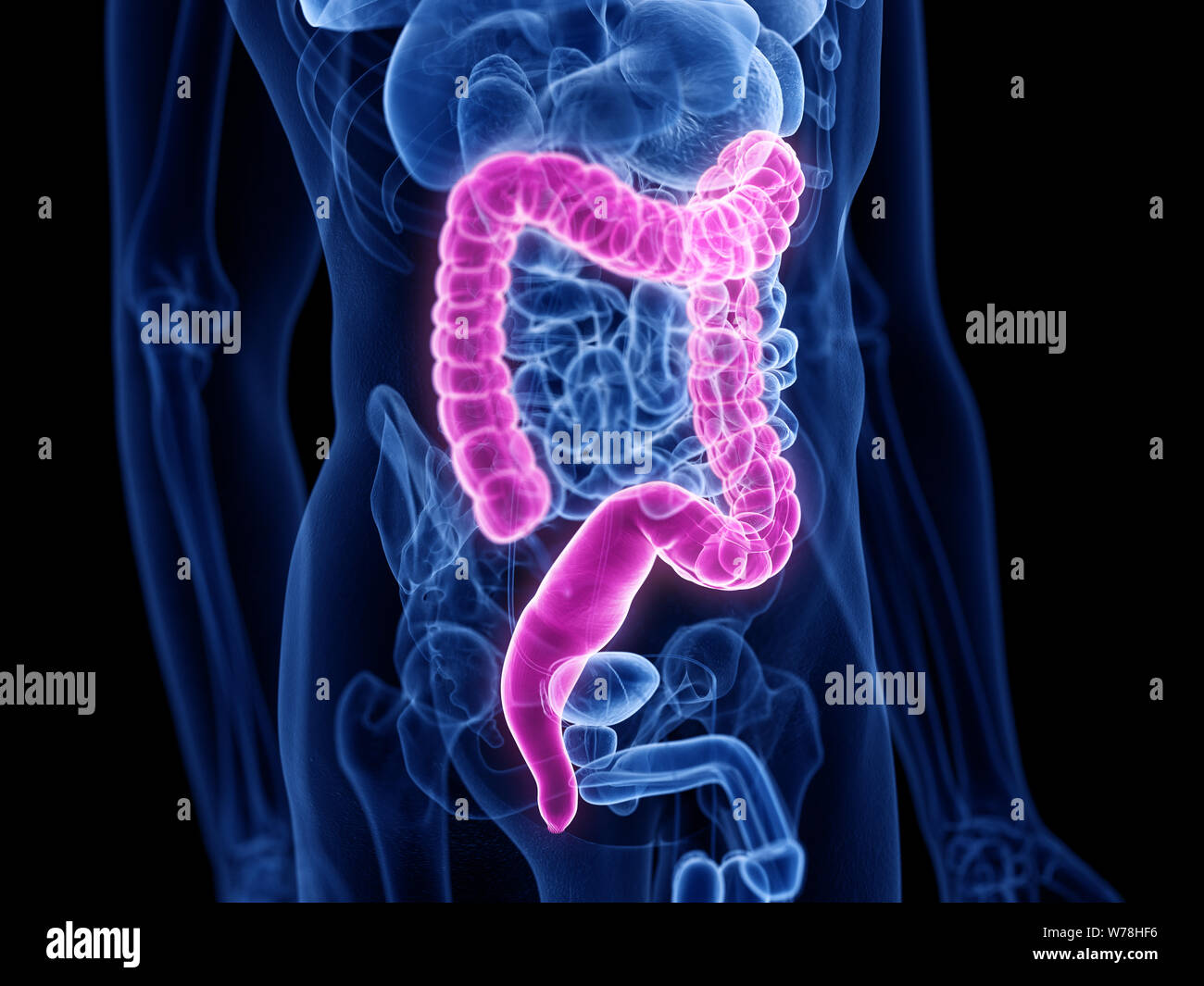Large intestine diverticulitis hi-res stock photography and images - Alamy