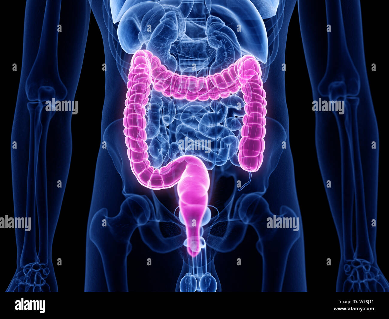 Large Intestine Diverticulitis High Resolution Stock Photography and ...