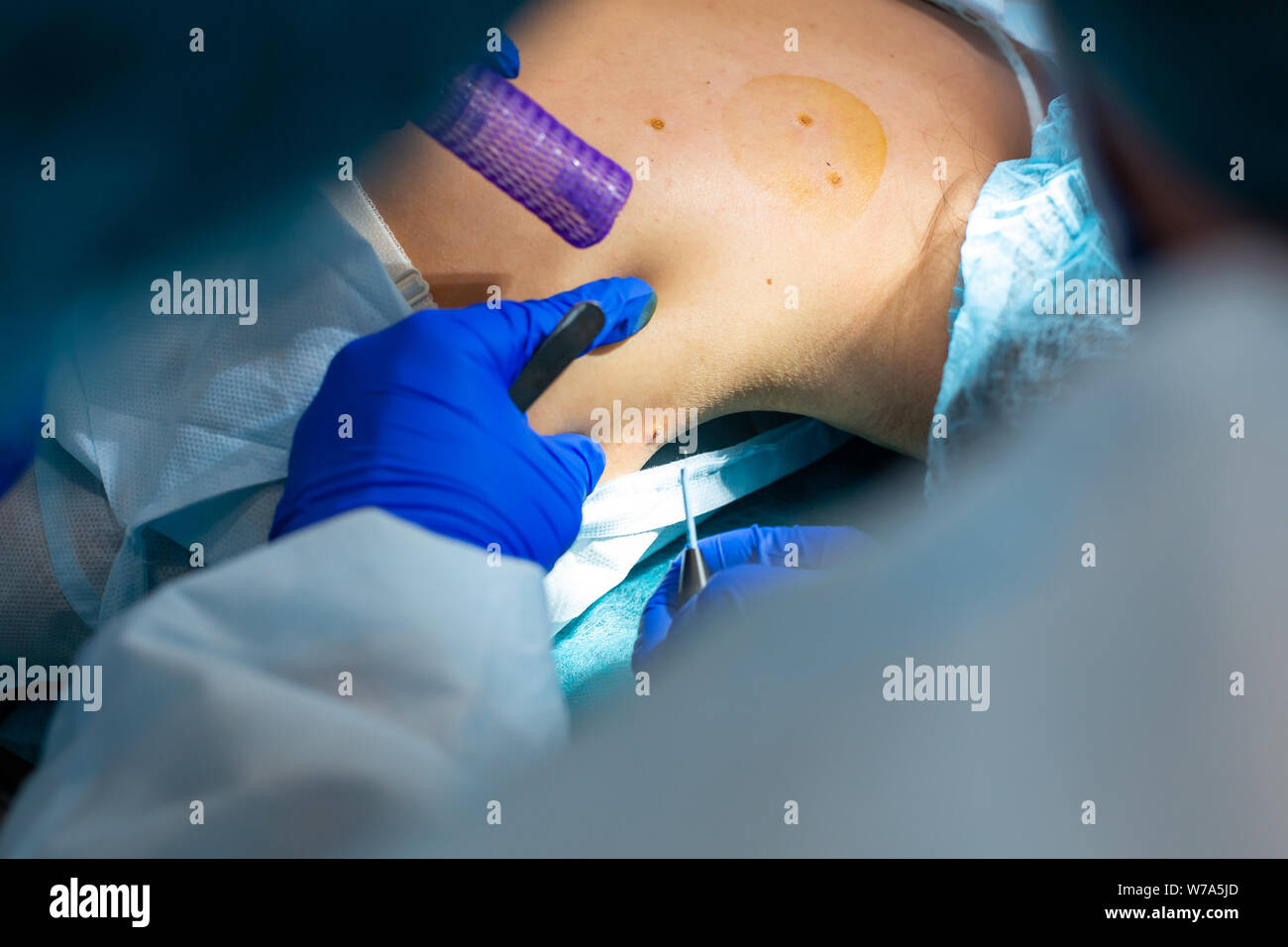 Malignant melanoma face hi-res stock photography and images - Alamy