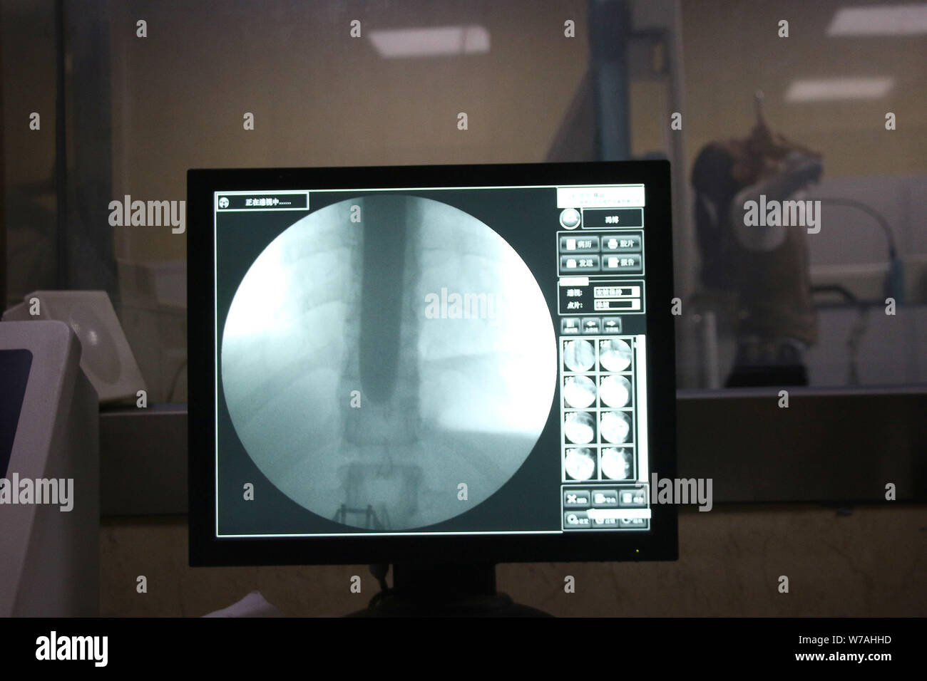The X-ray shows that the sword goes into the esophagus of Chinese ...