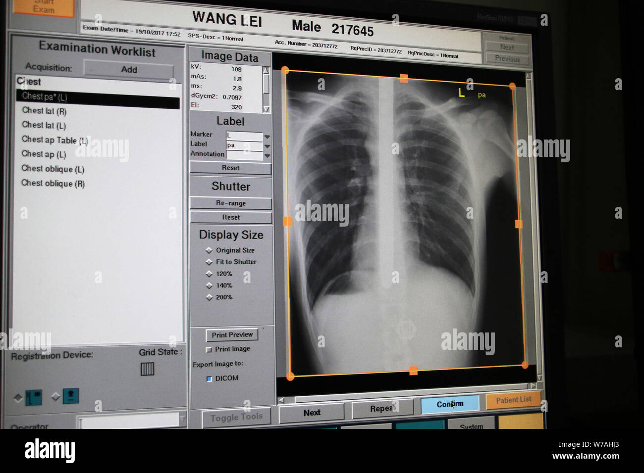 The X-ray shows that the sword goes into the esophagus of Chinese ...