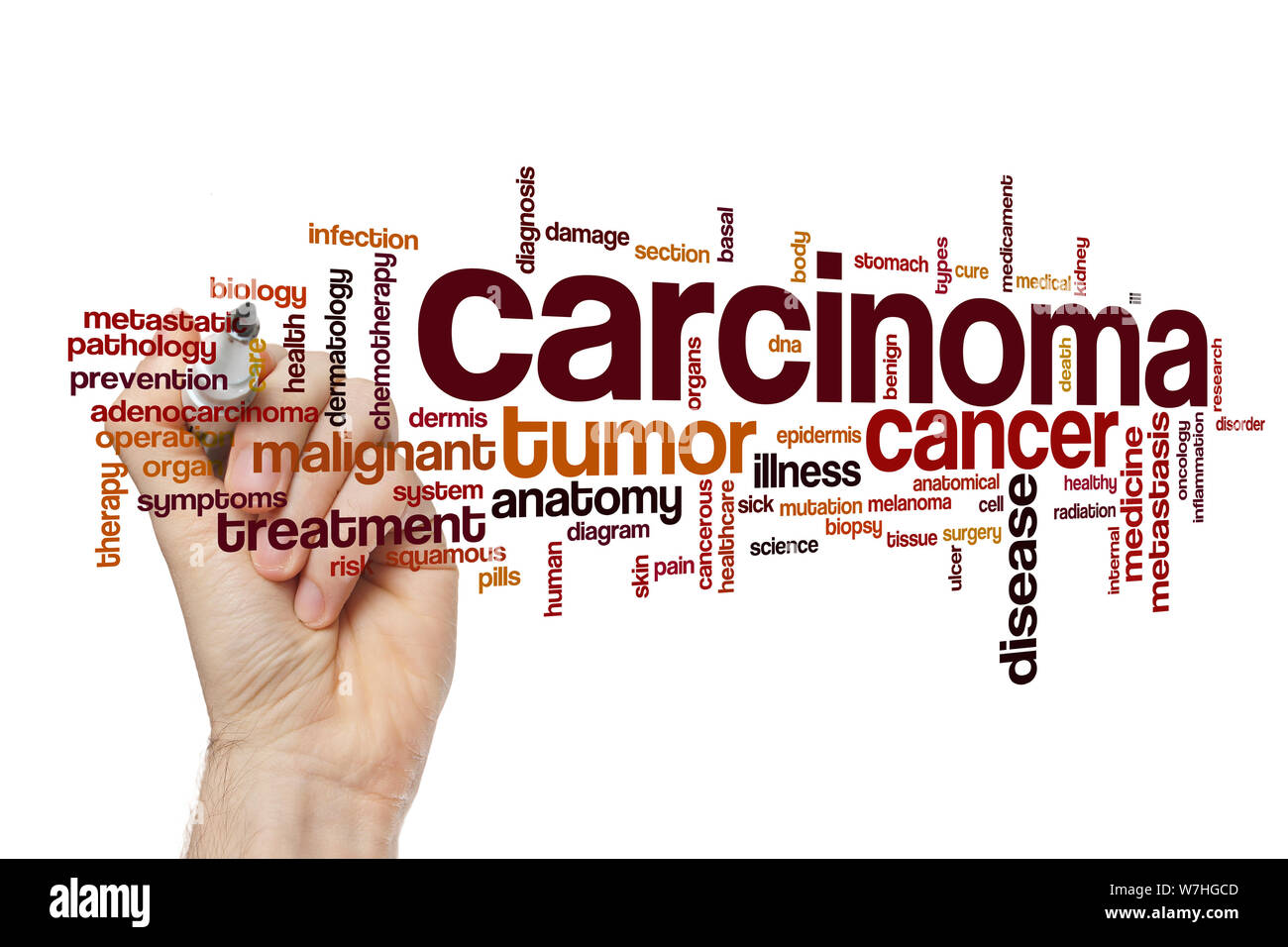 Human squamous cell carcinoma of the skin hi-res stock photography and ...