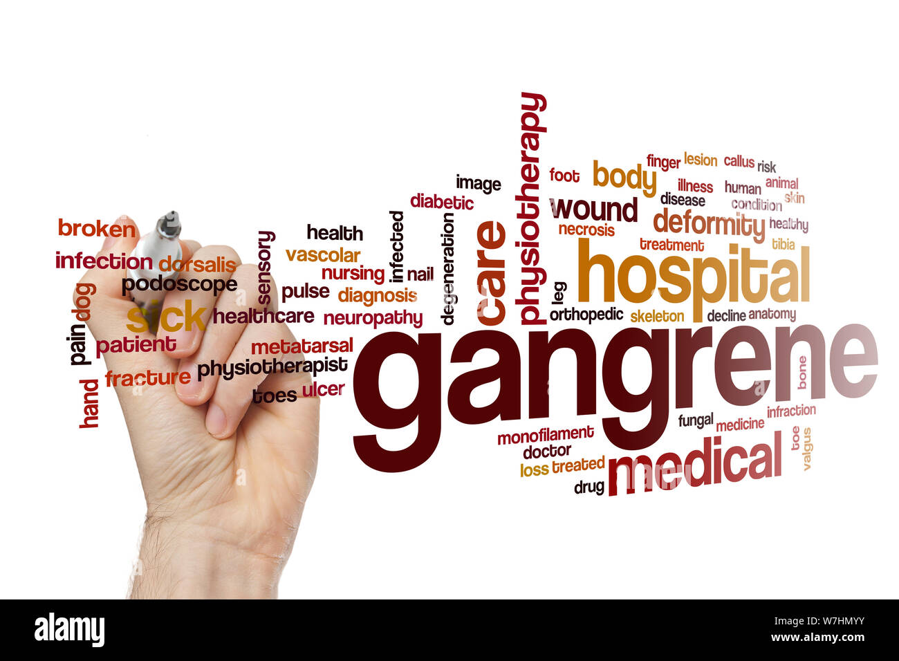 Gangrene foot hi-res stock photography and images - Alamy