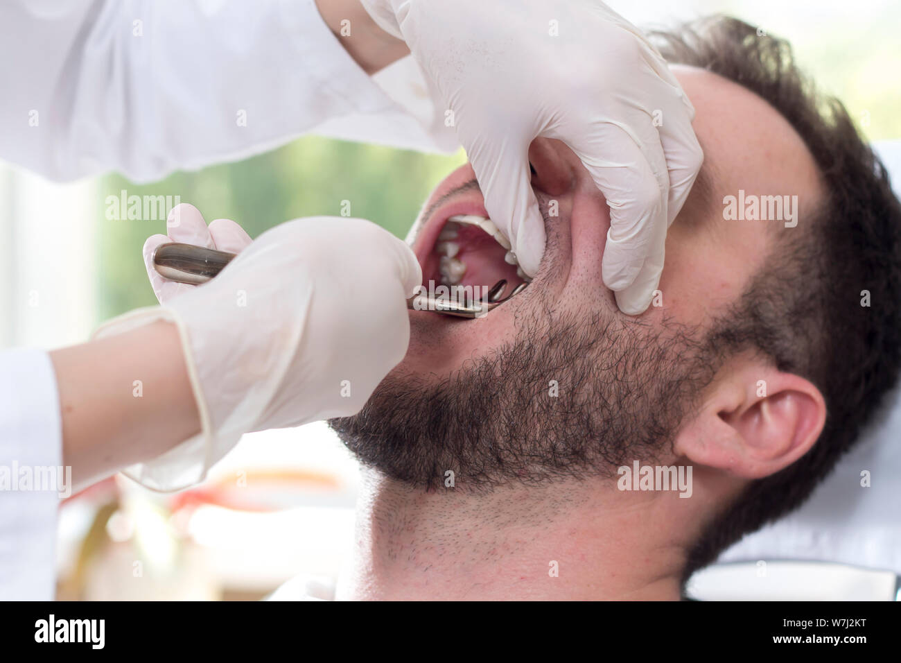 Tooth Extraction In A White Man The Doctors Hands Hold The Forceps And Catch The Tooth Stock