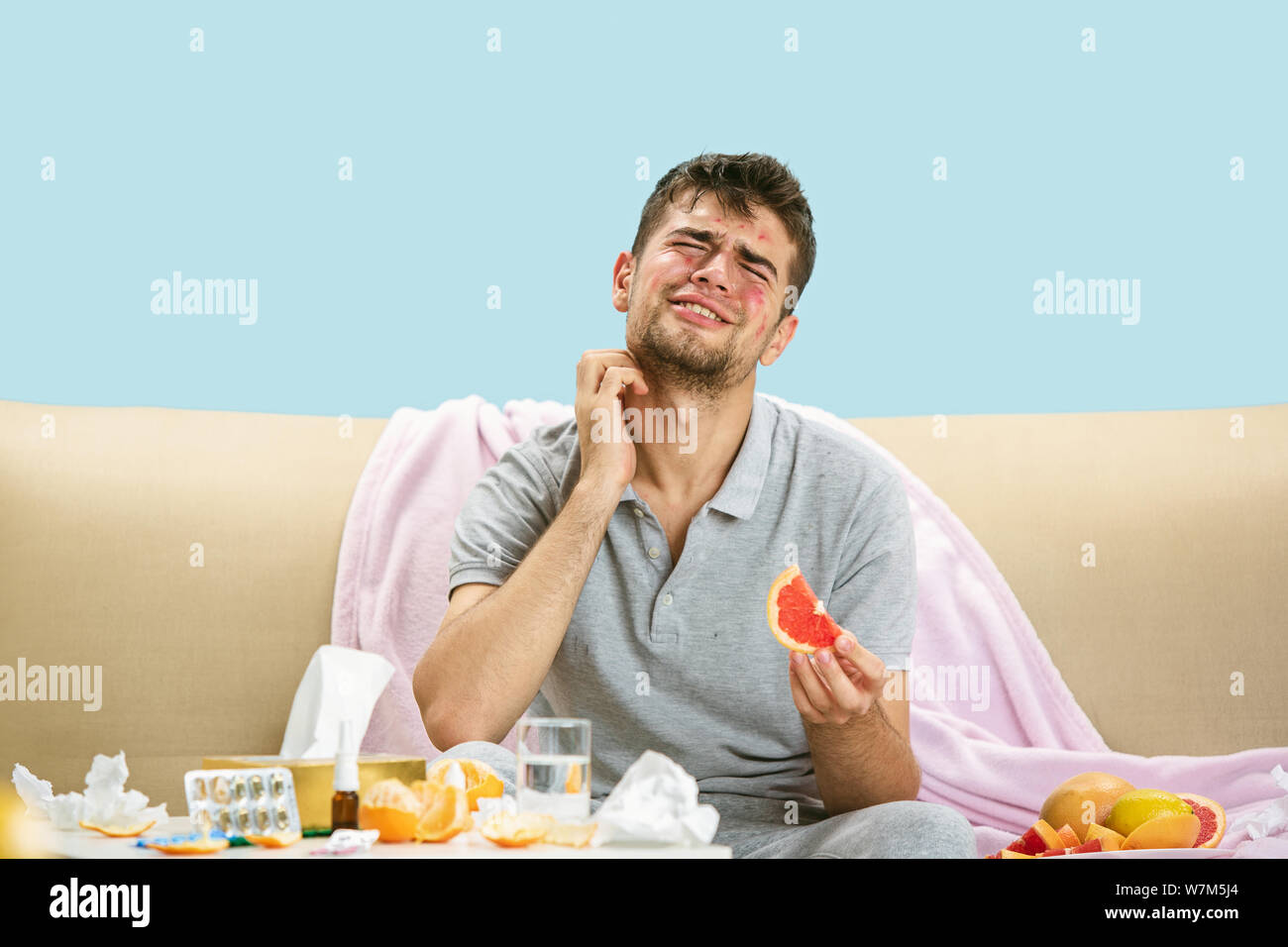 Young man suffering from allergy to citrus fruits. Having skin rash ...