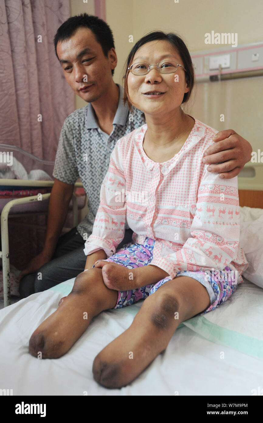 34-year-old tough Chinese woman without fingers and feet is pictured ...